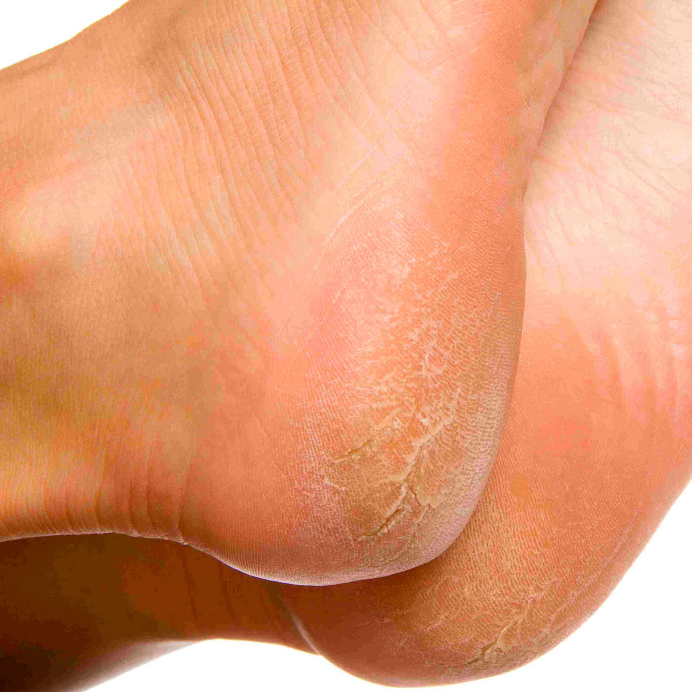 Corns & Callouses Treatment | Podiatrist Reservoir